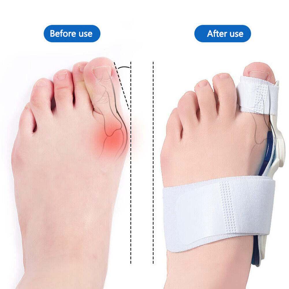 Hallux Valgus Corrector Orthotics Bunion Thumb Straightener Feet Adjus ...